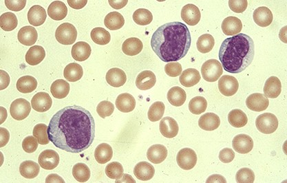 AM Report 04/11/17 Infectious Mononucleosis | SCVMC IM Chief Resident Blog