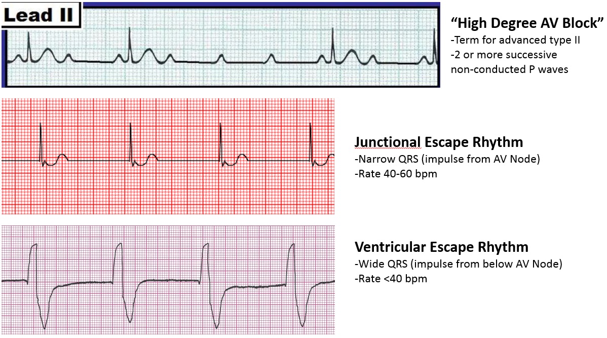 Heart Block 07/24/2017 | SCVMC IM Chief Resident Blog