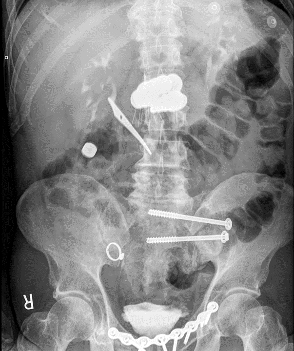 Abdominal Pain Secondary to… Lots of Foreign Bodies 11/6/2018 | SCVMC ...