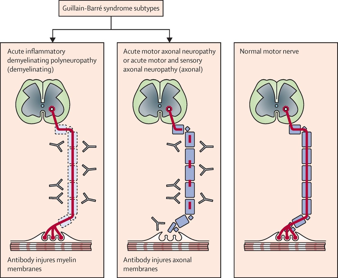 Recurrent AIDP vs CIDP vs sensory GBS variant 2/4/2019 | SCVMC IM Chief ...