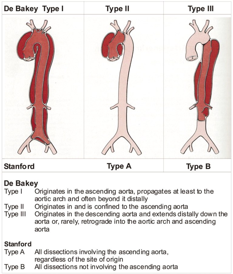 Stanford Type B Dissection in a Young Patient! 3/4/2019 | SCVMC IM ...