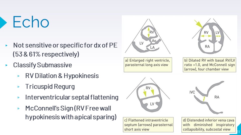 Submassive PE | SCVMC IM Chief Resident Blog